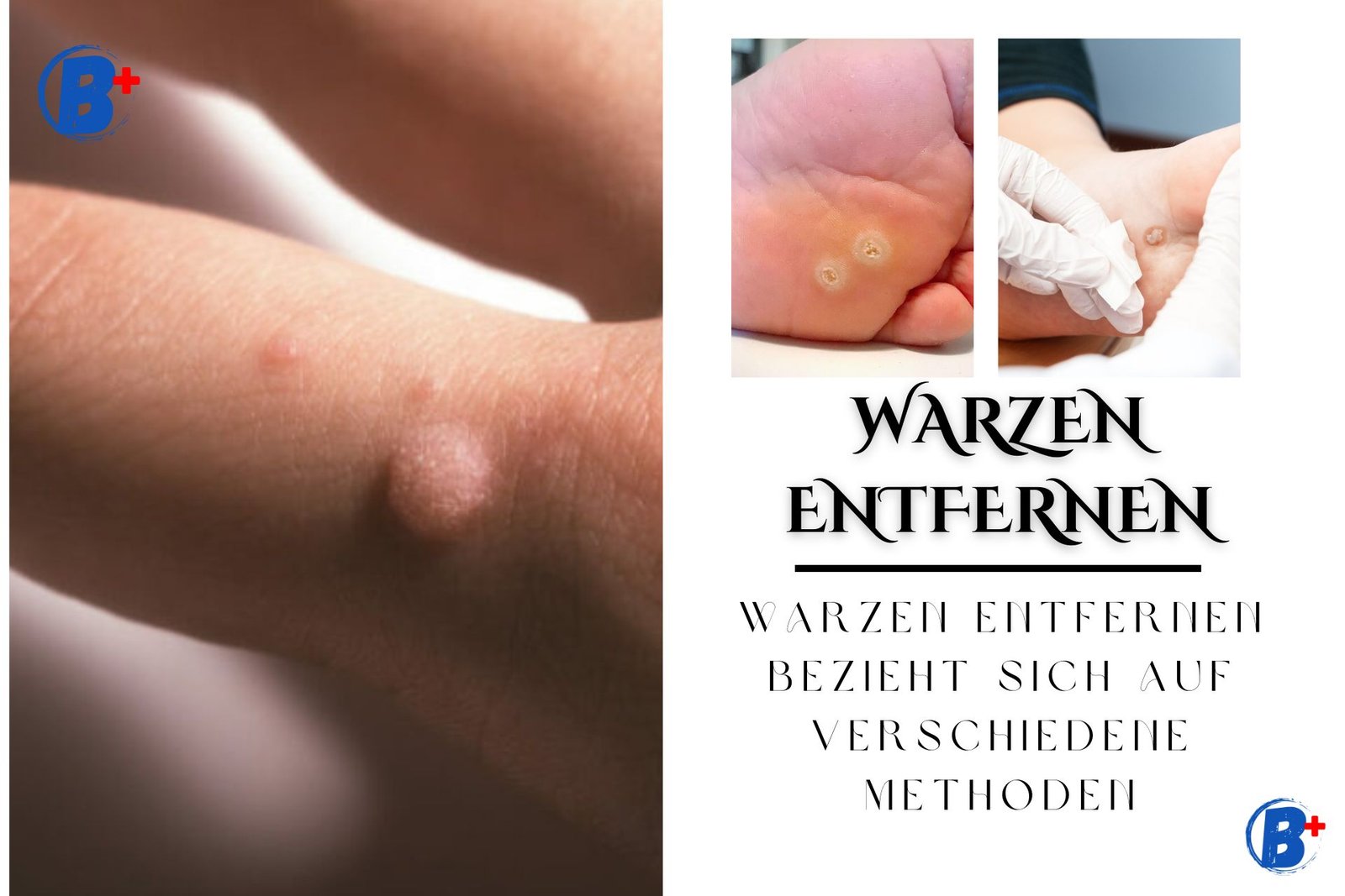 Warzen Entfernen: Tipps Vom Hautarzt Und Apotheke Für Schnelle Hilfe