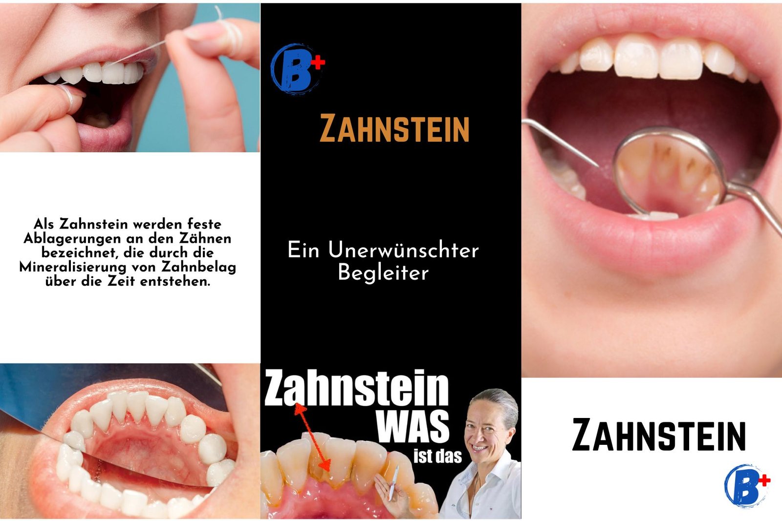Zahnstein – Ein Unerwünschter Begleiter